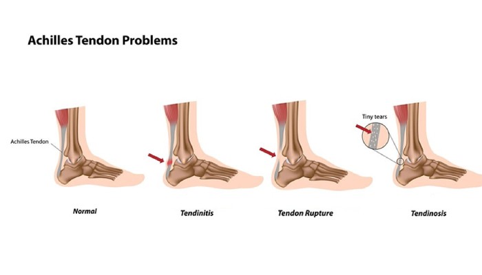 Runners Pain Dictionary – Part 3 - Vani Bhalla Pahwa
